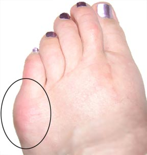 Bunionette Deformity - Foot & Ankle - Orthobullets